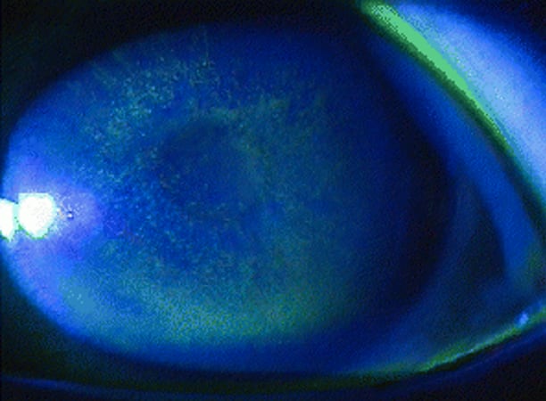 Fotoelektrisk keratit (Svetsblänk, Snöblindhet)