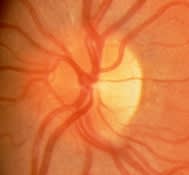 Optikusinfarkt – behandlingsöversikt | Internetmedicin