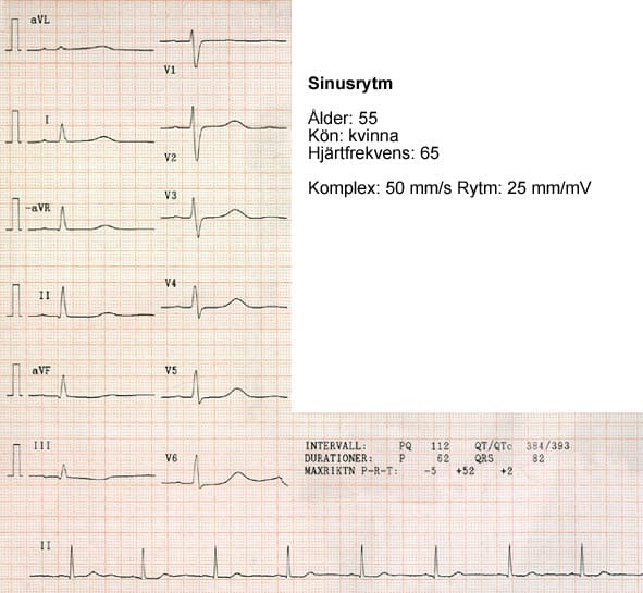 EKG-atlas, normalt EKG