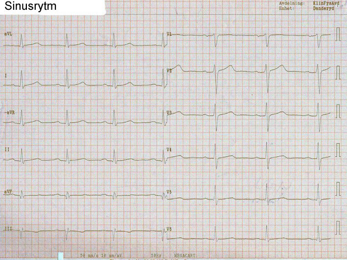 EKG-atlas, normalt EKG