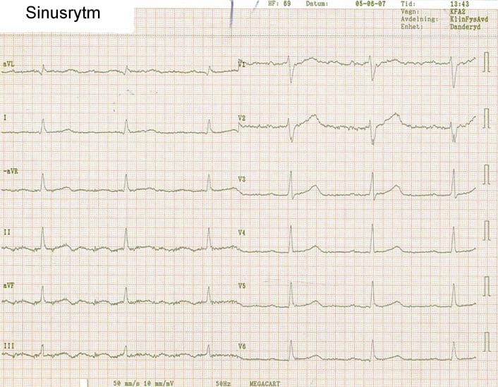 EKG-atlas, normalt EKG