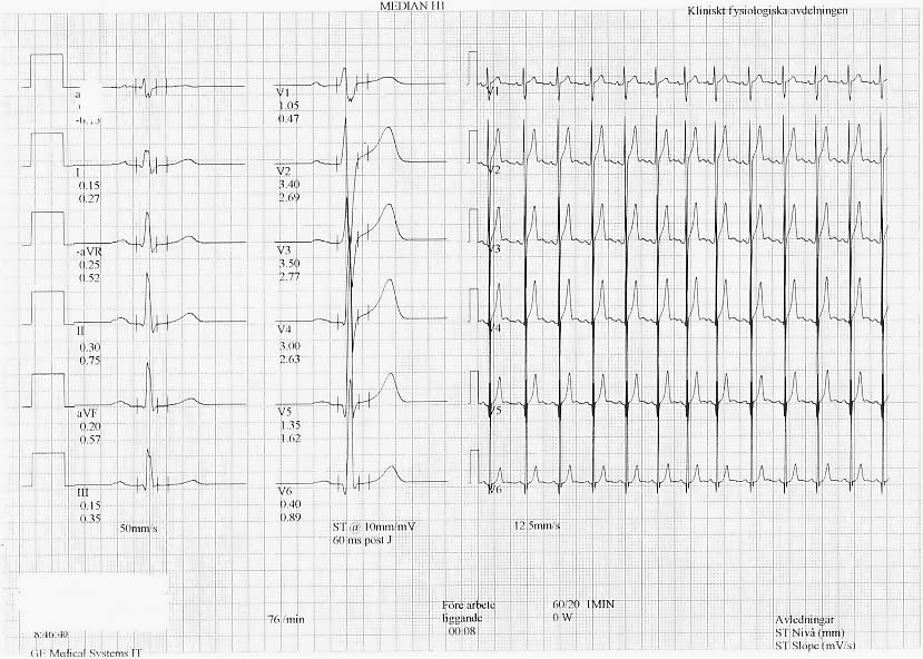 EKG-atlas, normalt EKG