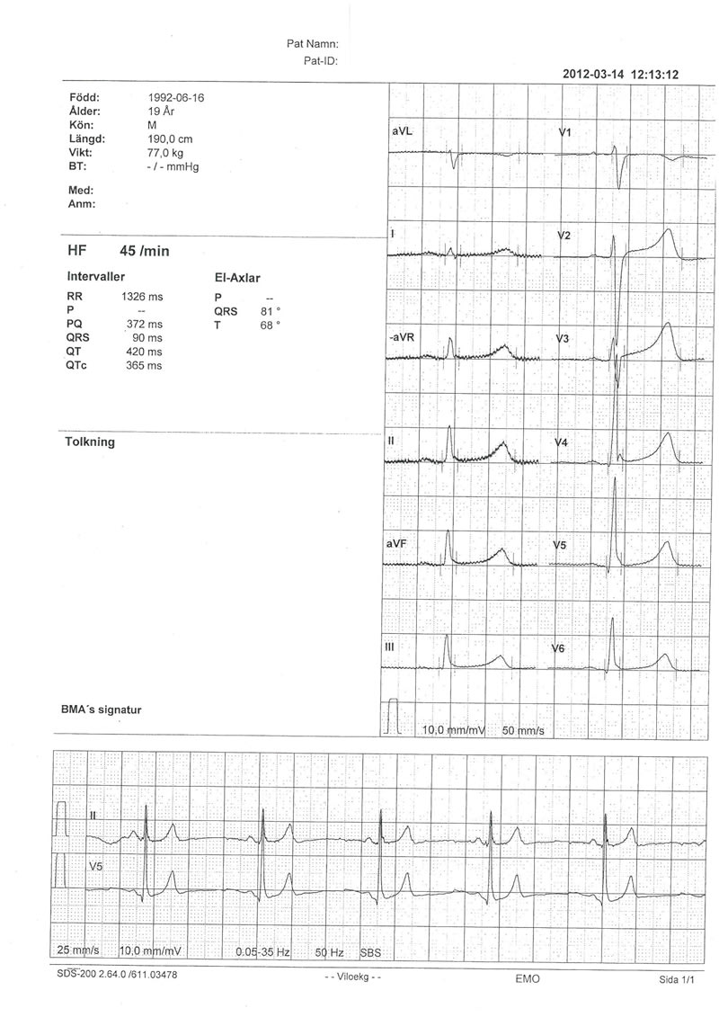 EKG-atlas, normalt EKG