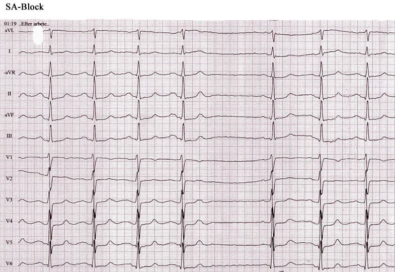 EKG-atlas, retledningshinder