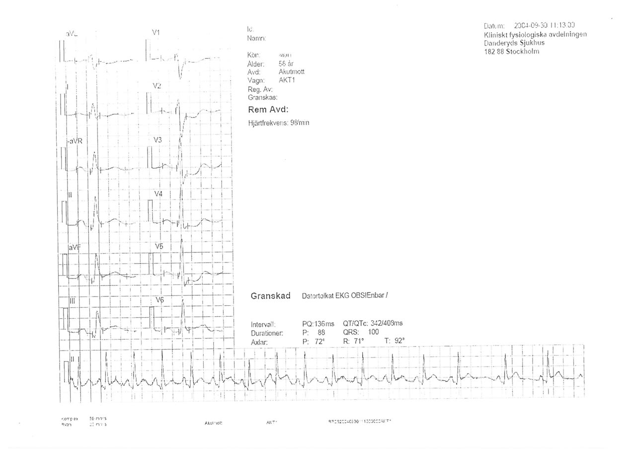 EKG-atlas, infarkt