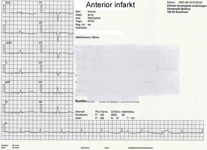 EKG-atlas, infarkt