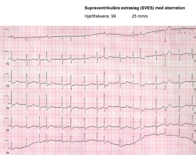 EKG-atlas, supraventrikulära arytmier
