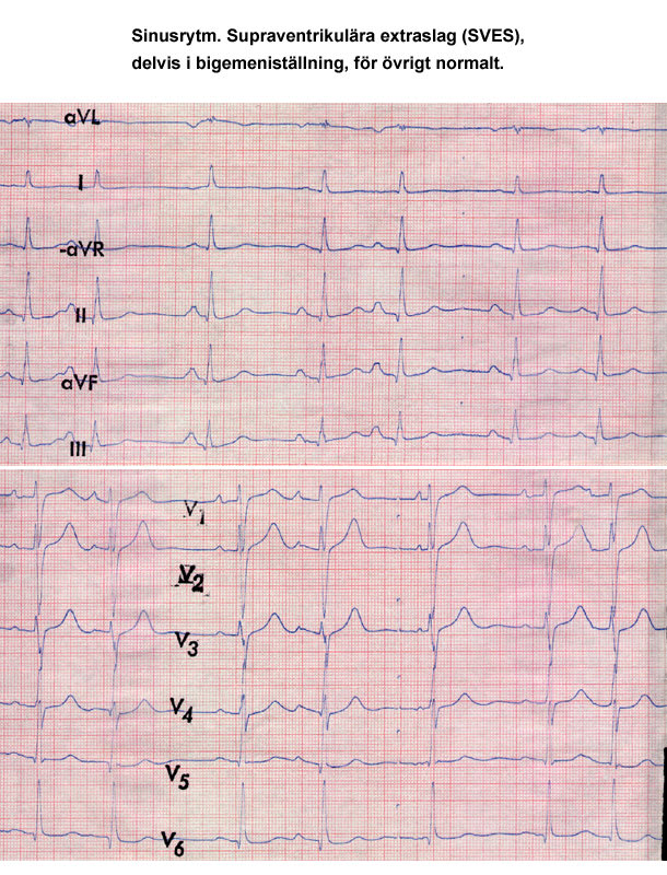 EKG-atlas, supraventrikulära arytmier
