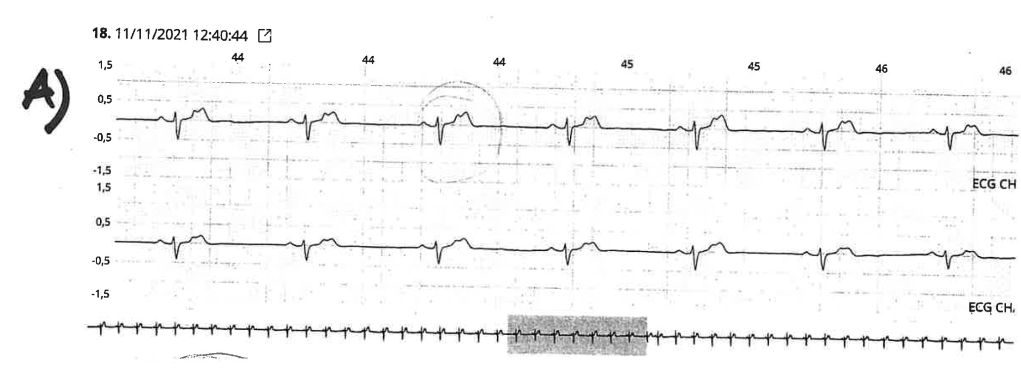EKG-atlas, supraventrikulära arytmier