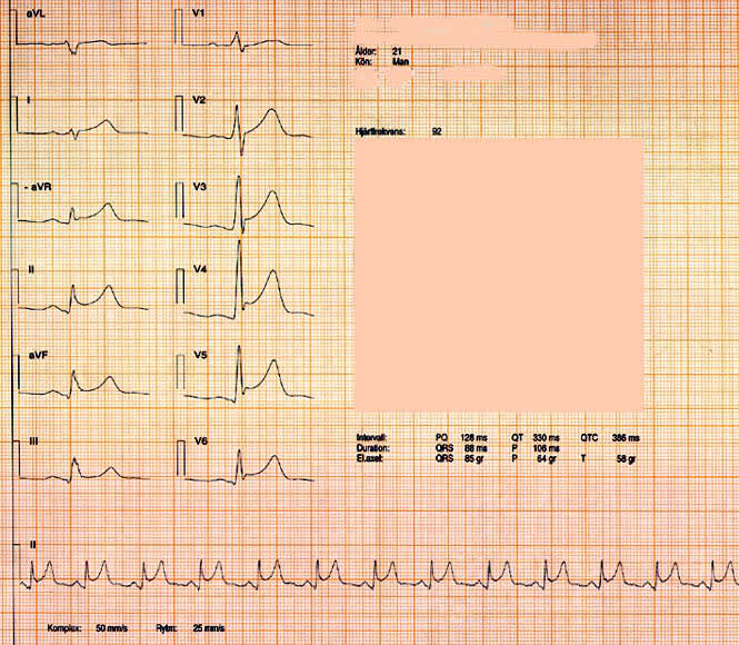 EKG-atlas, övriga tillstånd