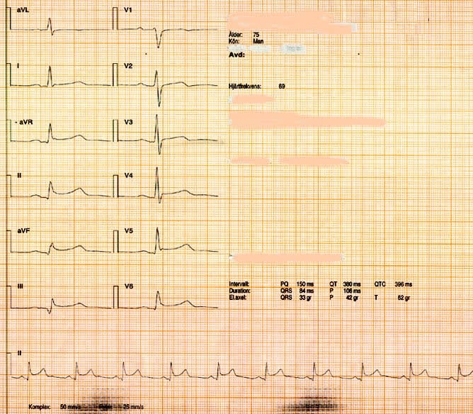 EKG-atlas, övriga tillstånd