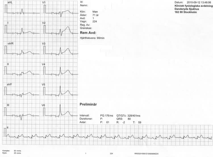 EKG-atlas, övriga tillstånd