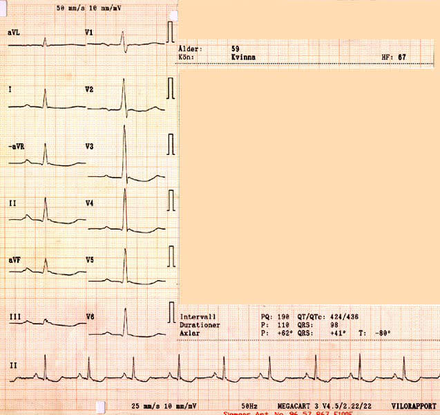 EKG-atlas, övriga tillstånd