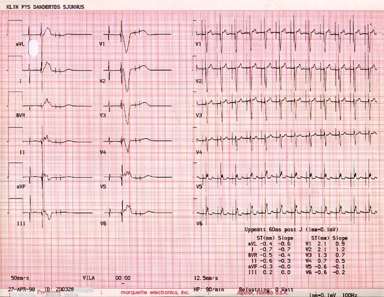 EKG-atlas, övriga tillstånd