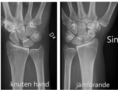 Handledssmärta – behandlingsöversikt | Internetmedicin
