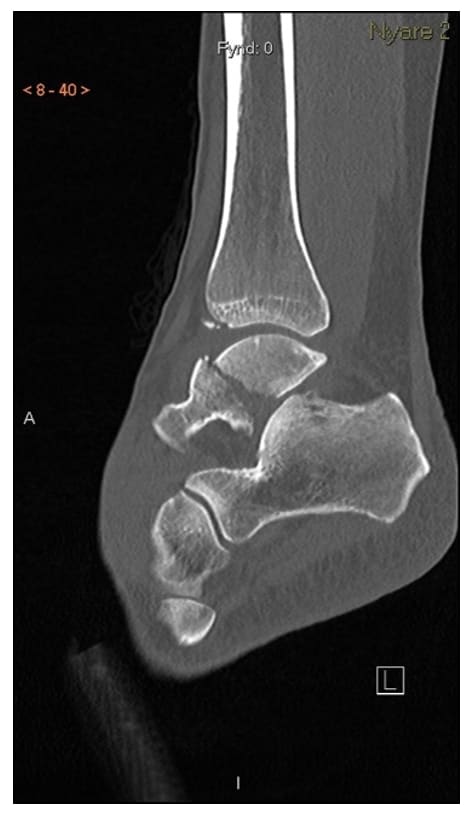 Calcaneus- och talusfrakturer, hos vuxna