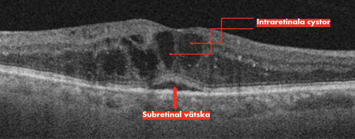 Diabetesmakulaödem (DME)