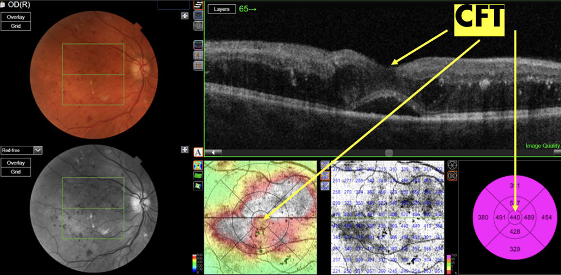 Diabetesmakulaödem (DME)