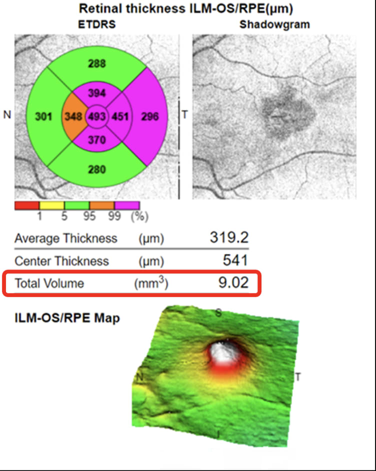 Diabetesmakulaödem (DME)