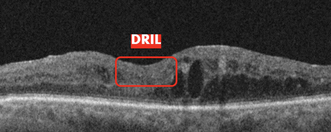 Diabetesmakulaödem (DME)
