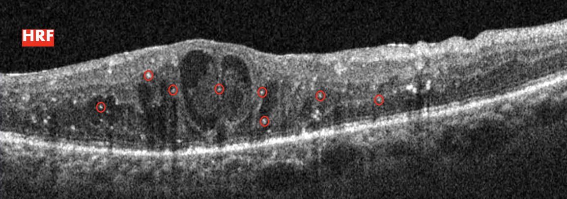 Diabetesmakulaödem (DME)