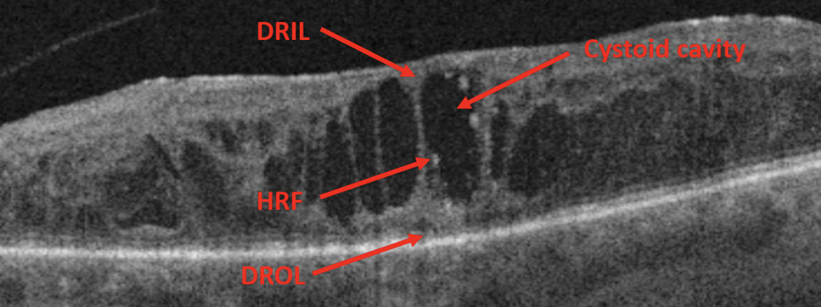 Diabetesmakulaödem (DME)