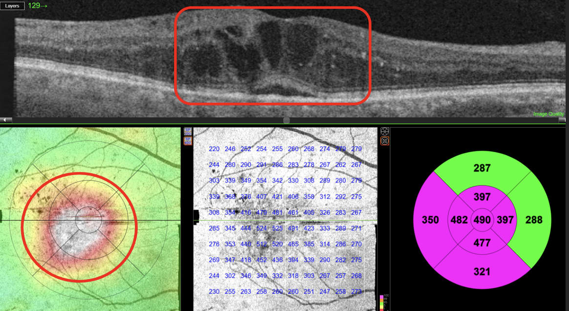 Diabetesmakulaödem (DME)