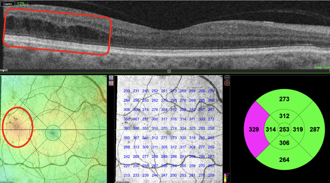 Diabetesmakulaödem (DME)