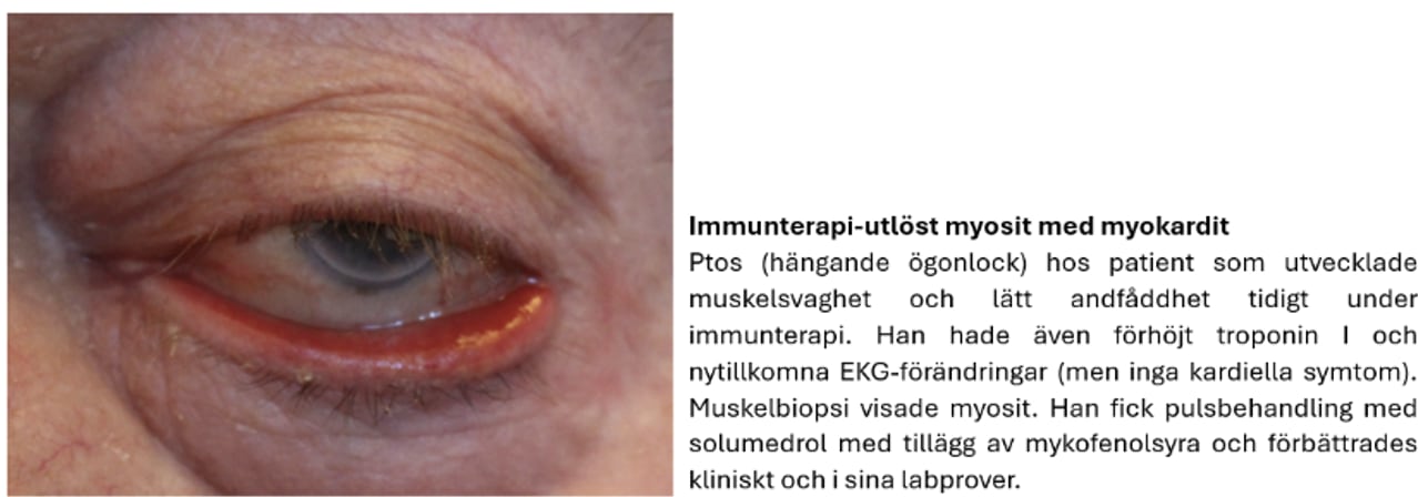 Immunrelaterade biverkningar vid cancerbehandling med ...