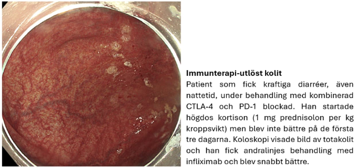 Immunrelaterade biverkningar vid cancerbehandling med ...