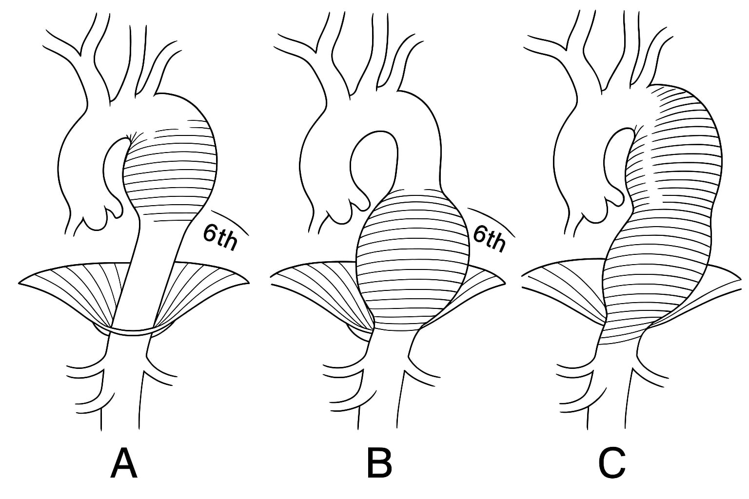 Aortaaneurysm, torakalt - aorta descendens och torakoabdominella aorta
