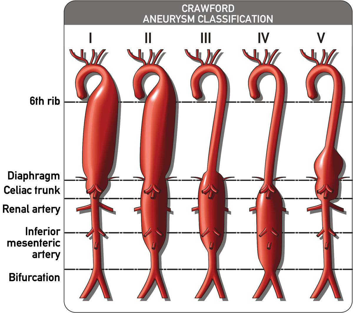 Aortaaneurysm, torakalt - aorta descendens och torakoabdominella aorta