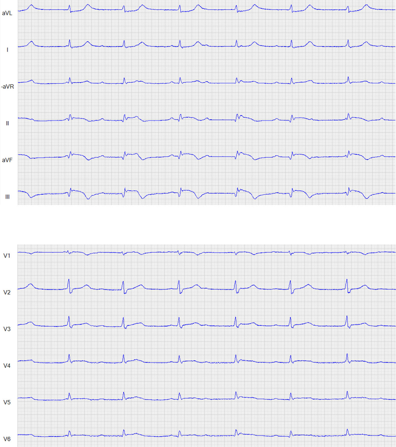 EKG-atlas, infarkt