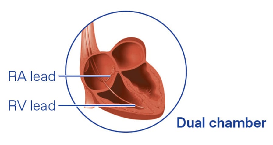 biventricular pacemaker surgery