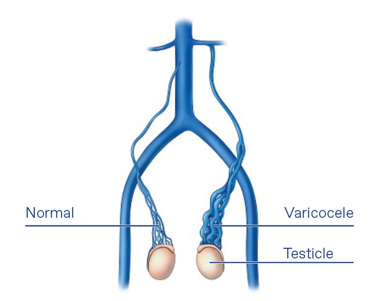 Varicocele Embolization Through Neck