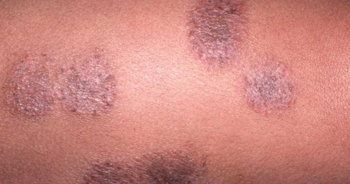 Psoriasis Skin Rash