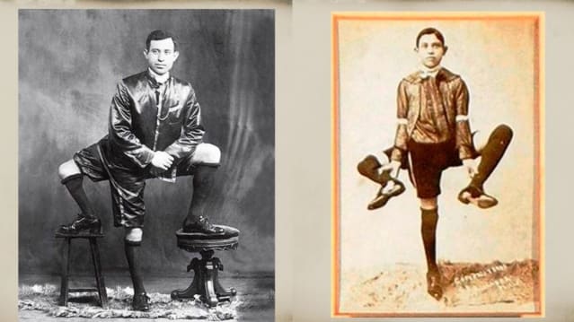 The 'Three-Legged Man' Frank Lentini Facts and Stories | Education