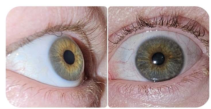 Human Eye Mutations