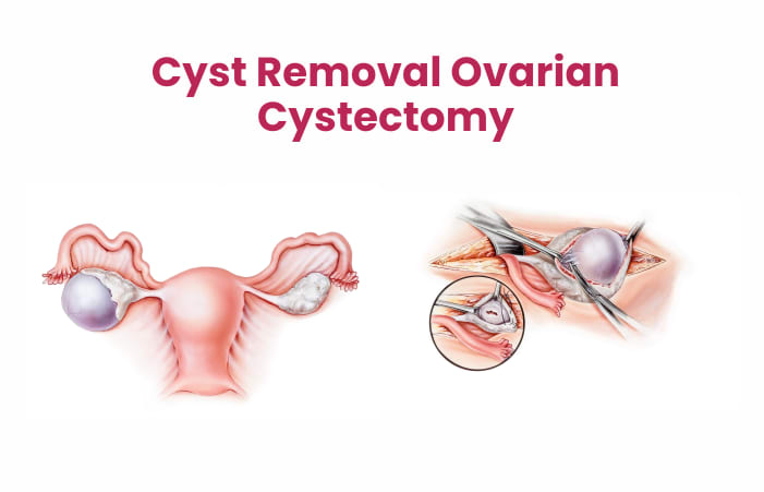 Ovarian Cyst Removal Medical Term