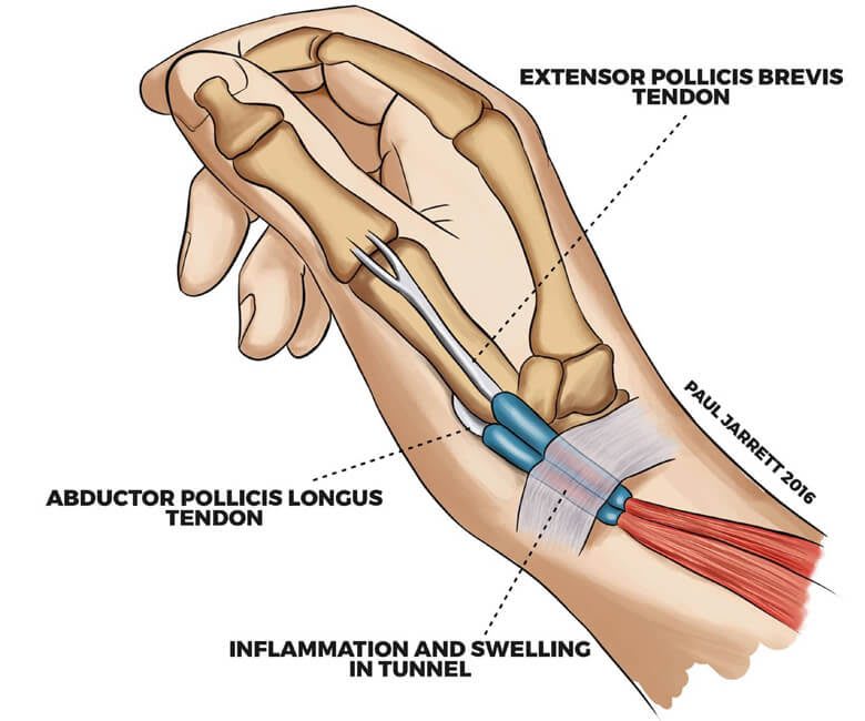 De Quervain Tenosynovitis Symptoms Causes Treatment Plan De Quervain Tenosynovitis Symptoms Causes Treatment Plan