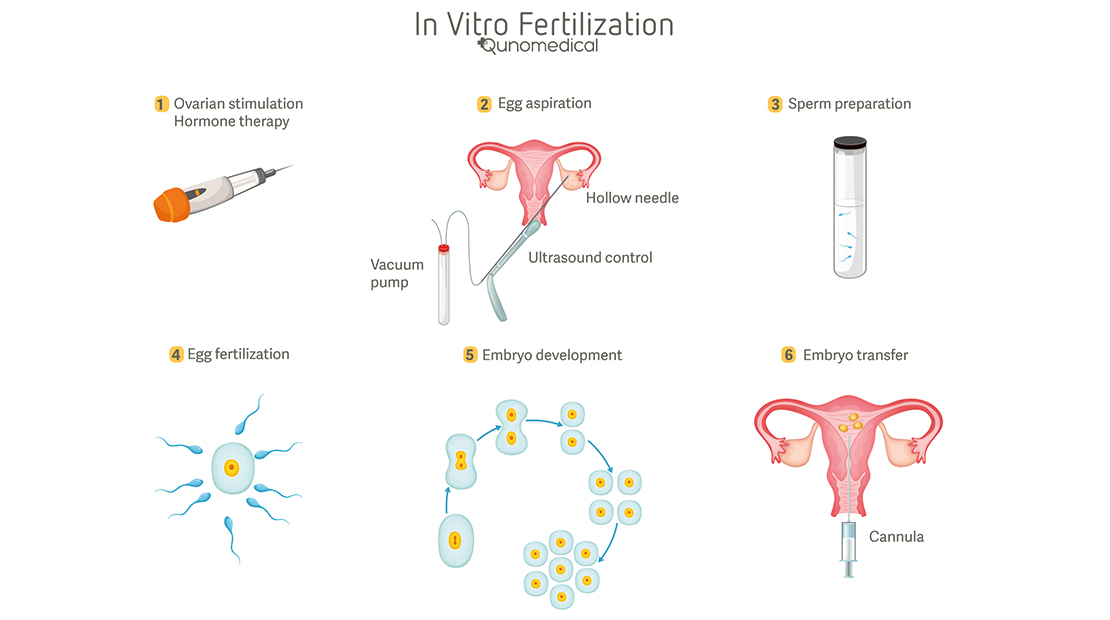 In Vitro Fertilization Process