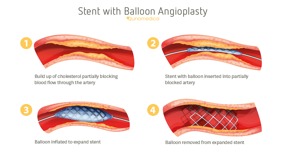 Coronary Artery Stent