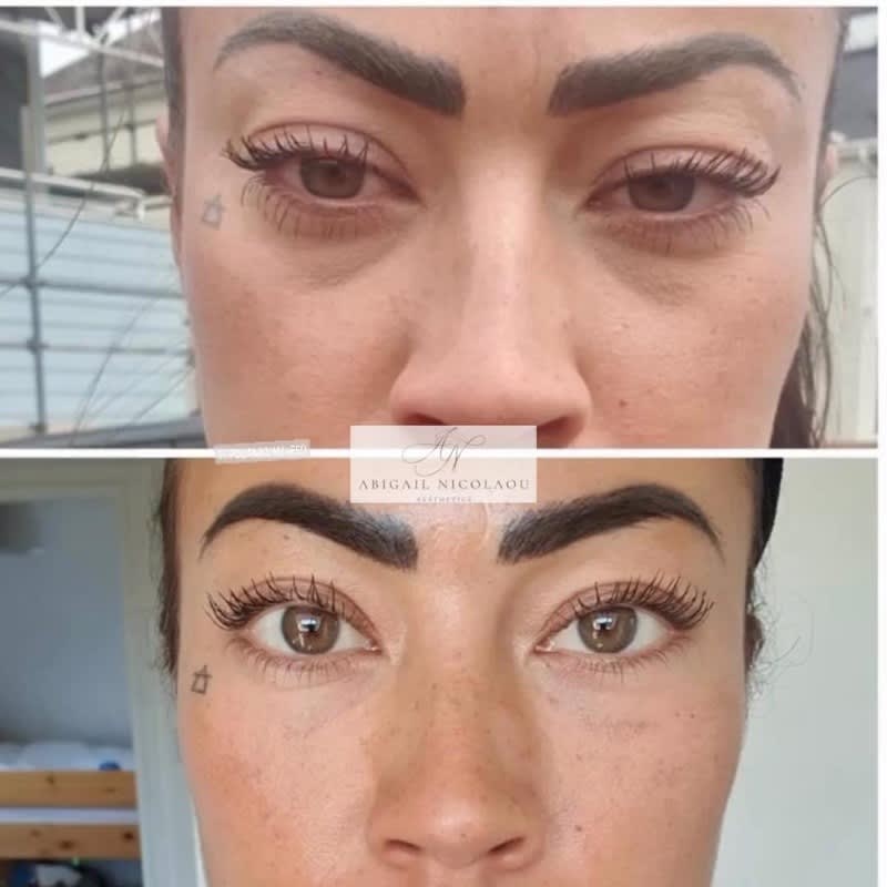 Gallery - AN Aesthetics - ADVANCED, SKILLED, SAFE AESTHETICS.