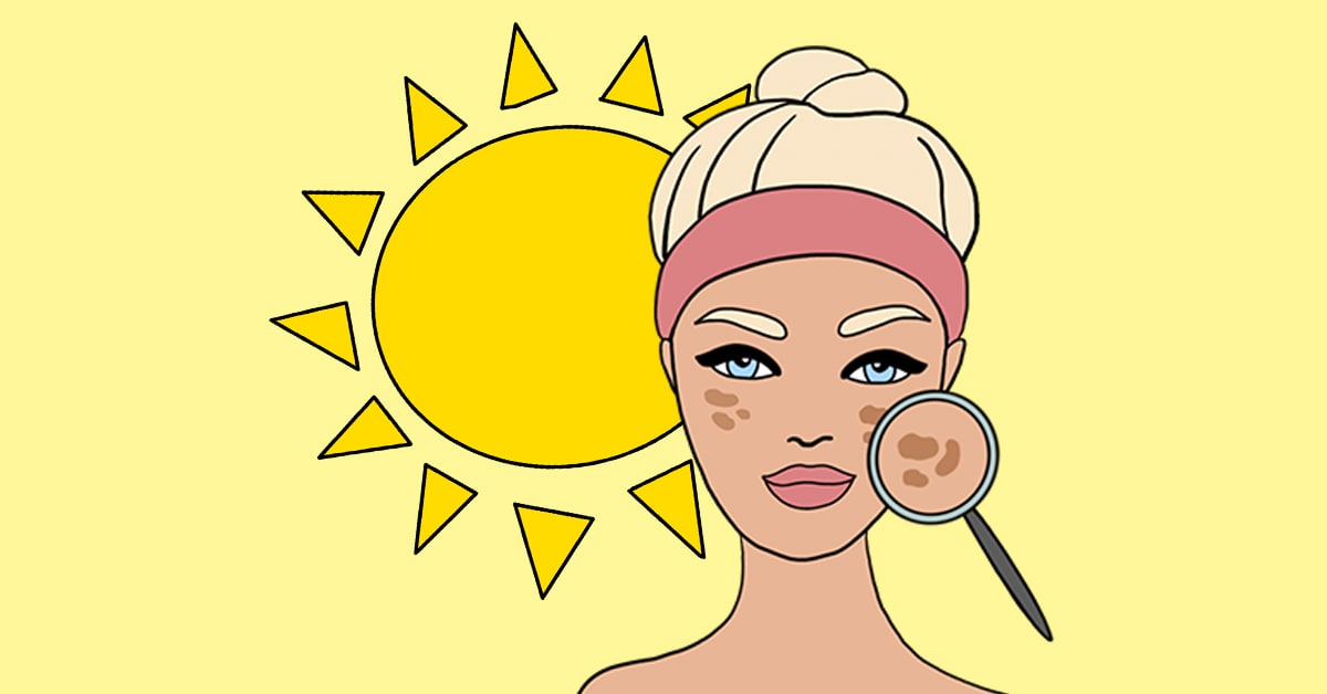 How to Treat Hyperpigmentation Caused by Sun Exposure - LaserAway