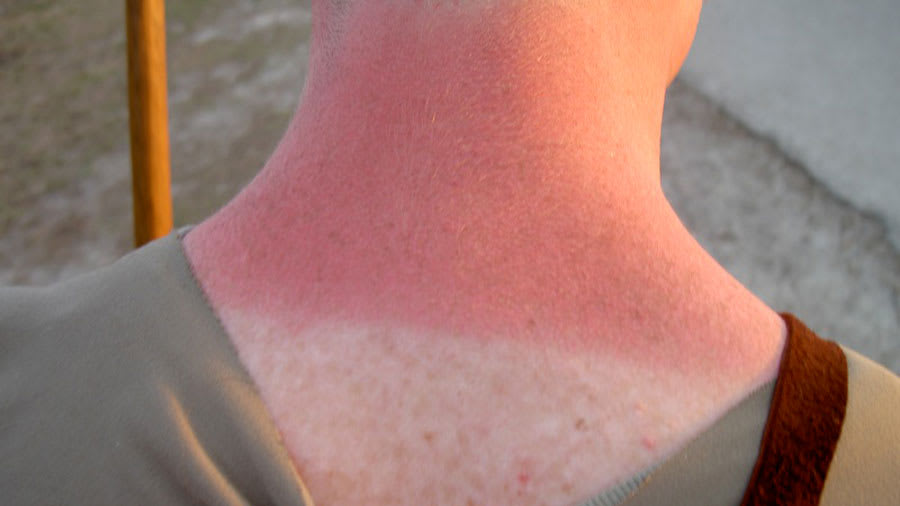 Sunburn: Symptoms, Causes, and Treatments | LearnSkin