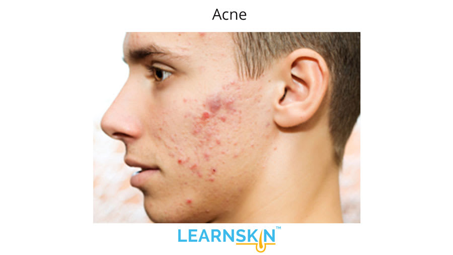 Acne: Symptoms, Causes, Treatments | LearnSkin