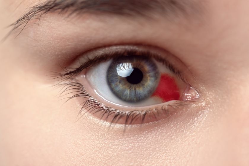 Managing a Burst Blood Vessel in Your Eye: A Complete Guide