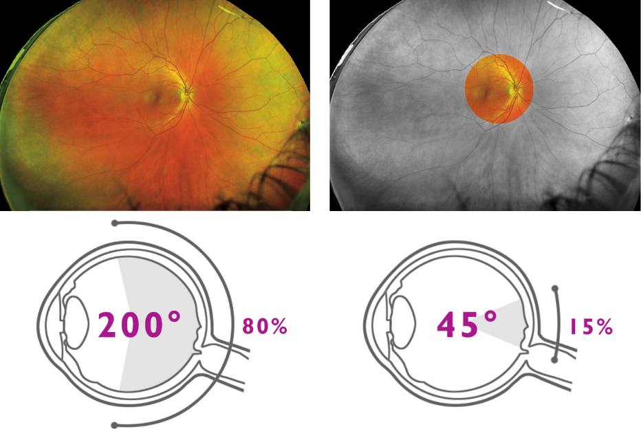 Optomap Eye Examination | Leightons