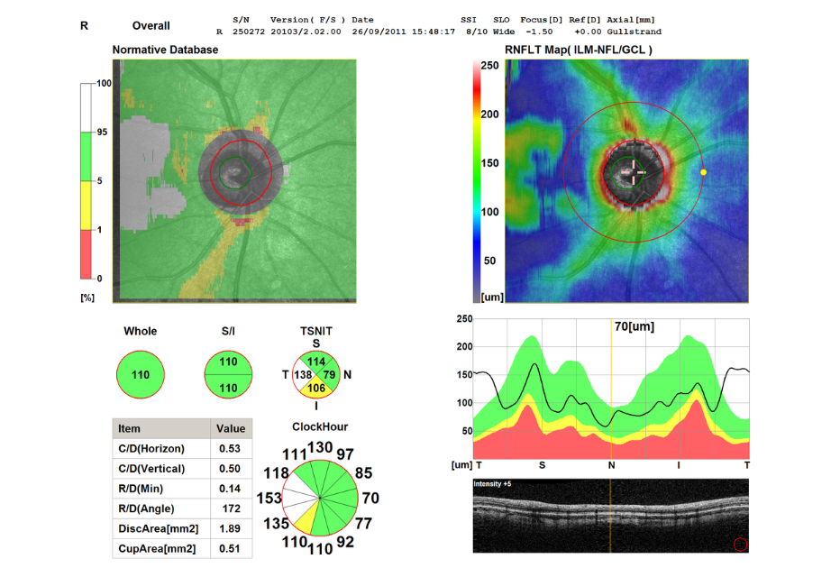 OCT Scan & Eye Test | Optical Coherence Tomography | Leightons