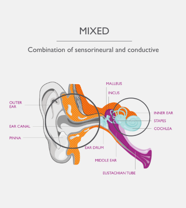 Hearing Loss Advice | Symptoms, Causes & Treatment | Leightons